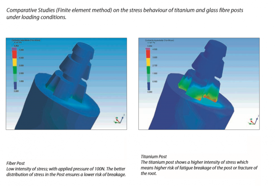 Root post Restoration Systems | Premiere Dental Sdn Bhd | Malaysia