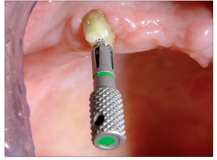 Root Post Restoration Systems | Premiere Dental Sdn Bhd | Malaysia